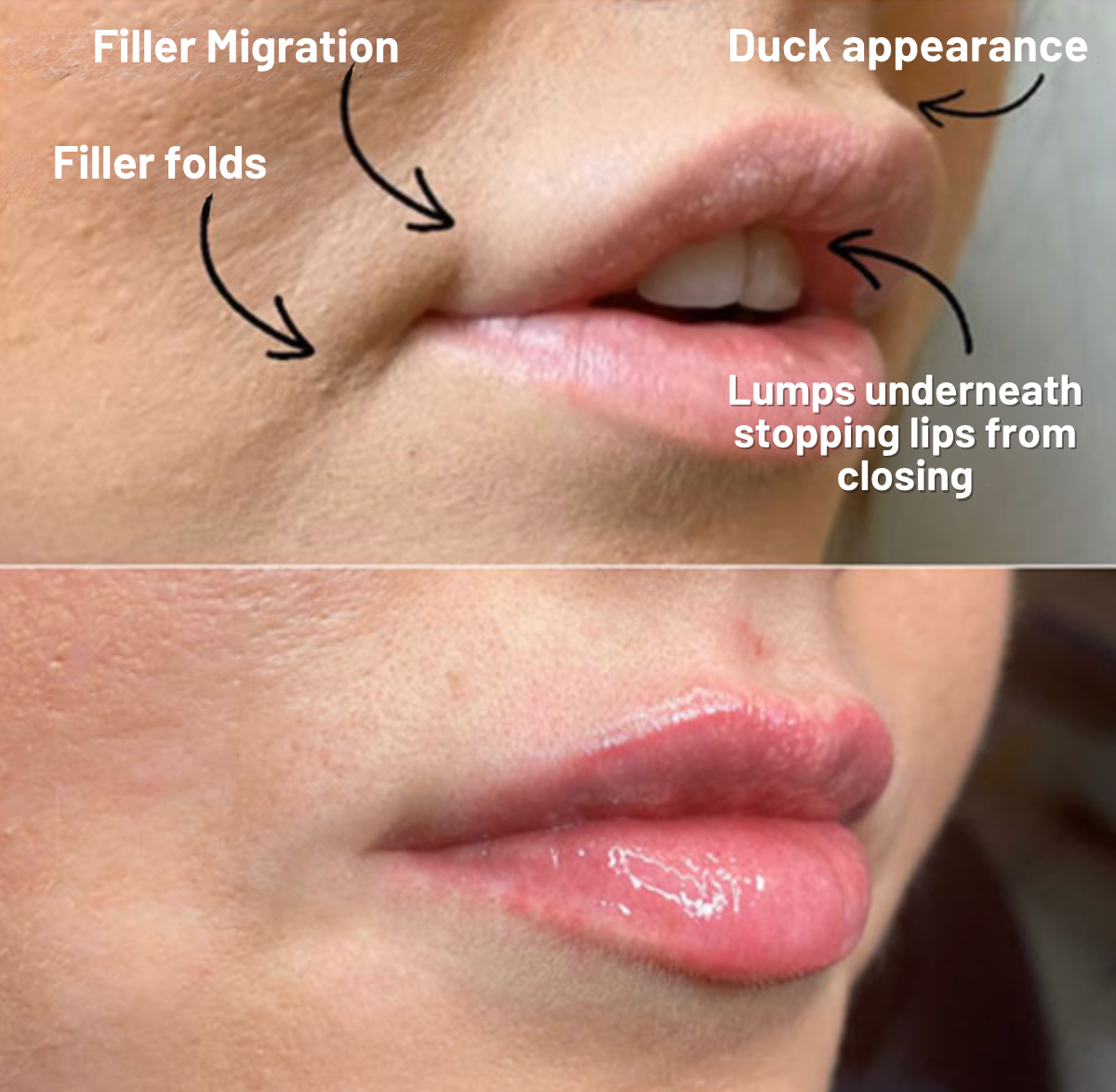 Lip Filler Migration: What It Is, What Causes It & How We Fix It